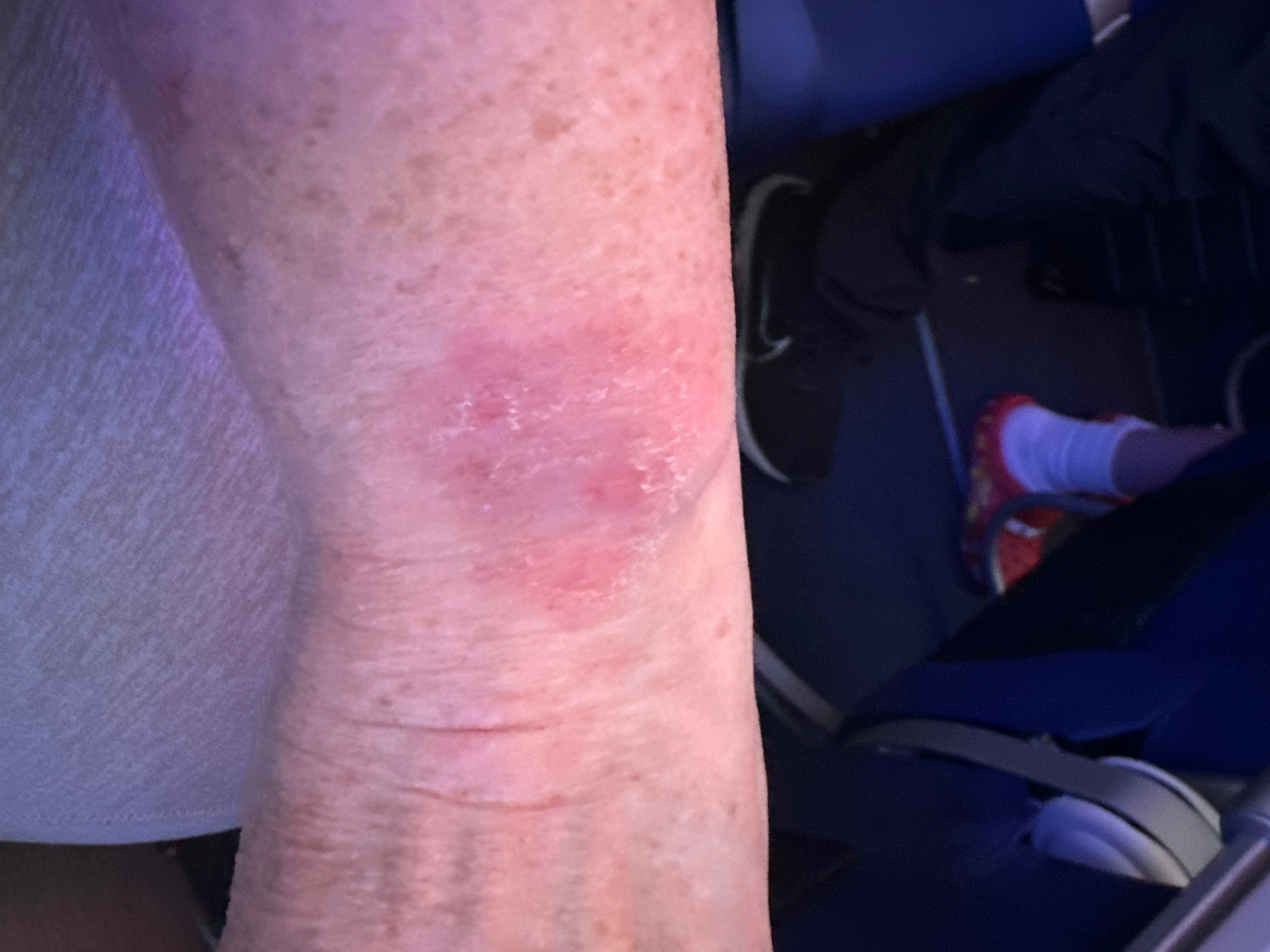 Wrist burns from Apple Watch 9 - Apple Community