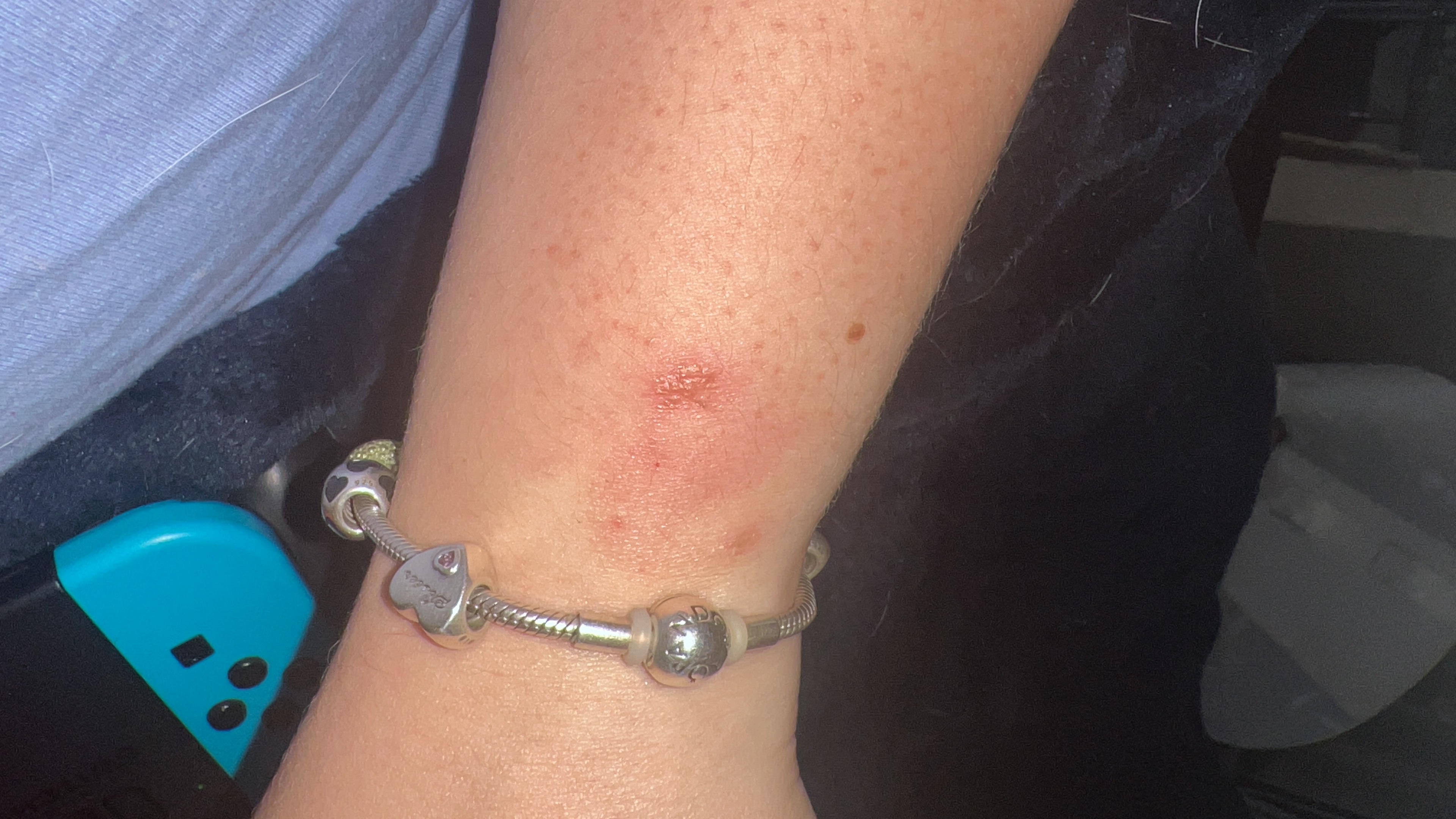 Watch burns? - Apple Community