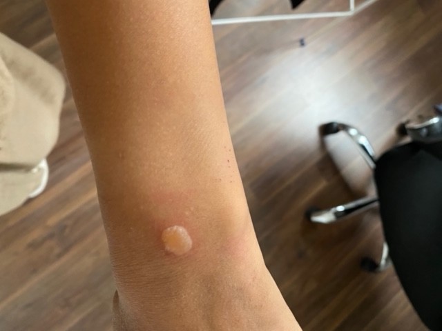 Apple series 6 watch burn - Apple Community