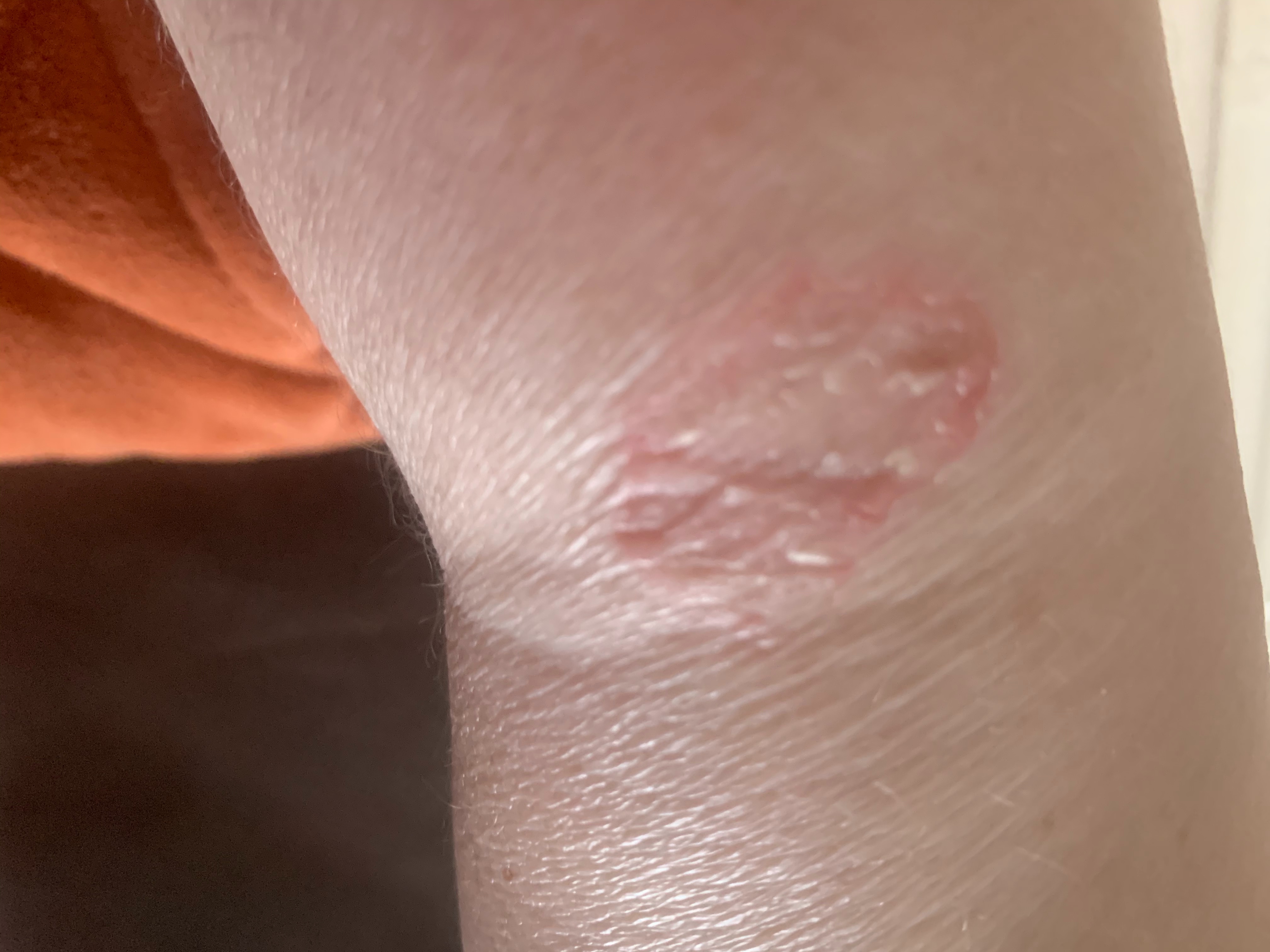 Sensor burn series 3 Apple Watch - Apple Community