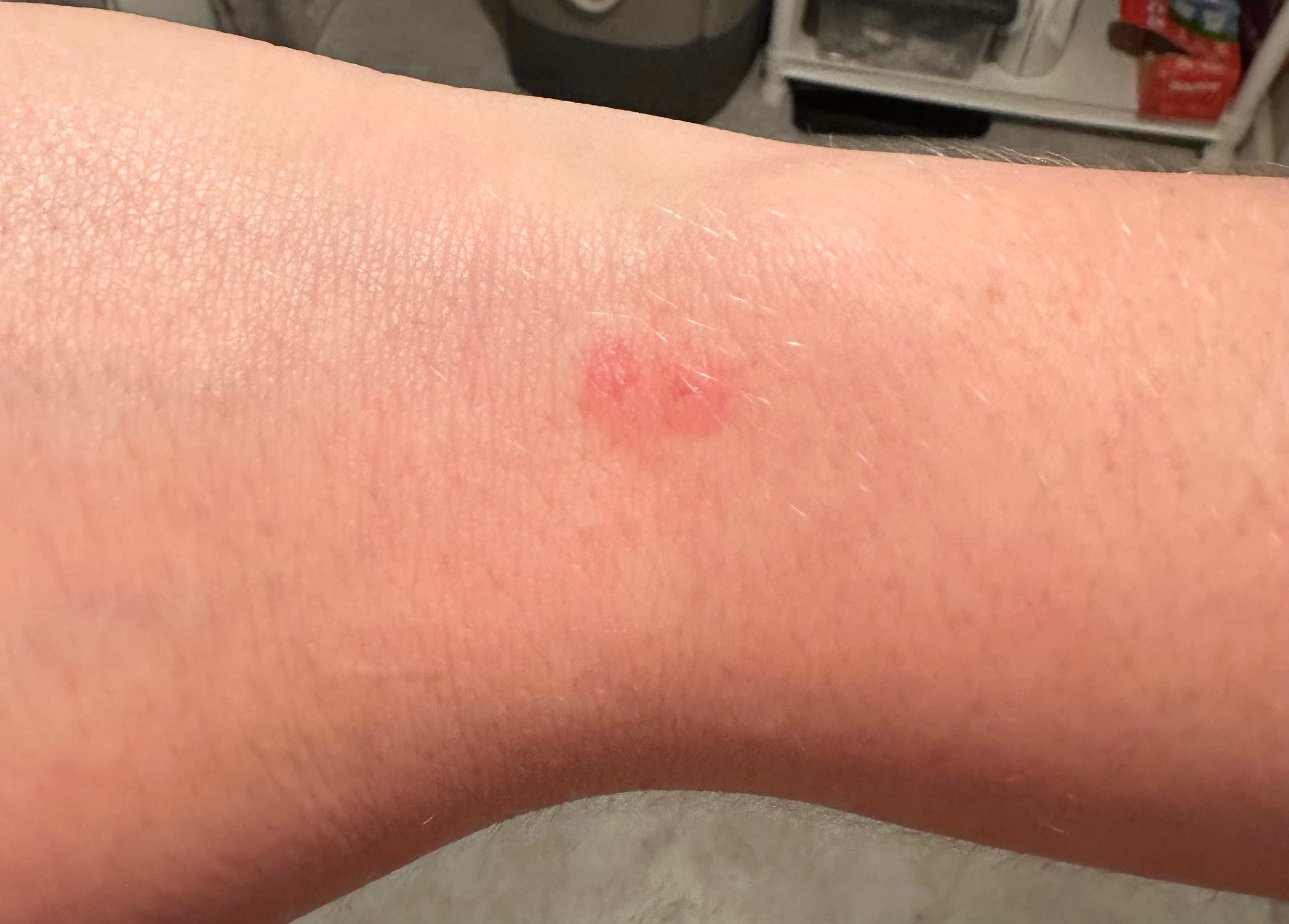 Apple Watch strap causing skin irritation… - Apple Community