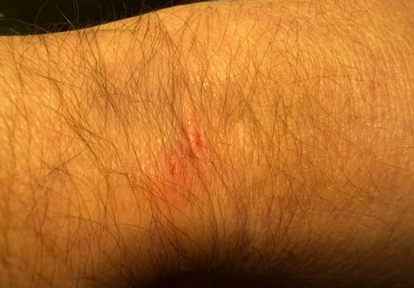 Wrist burns from Apple Watch 9 - Apple Community
